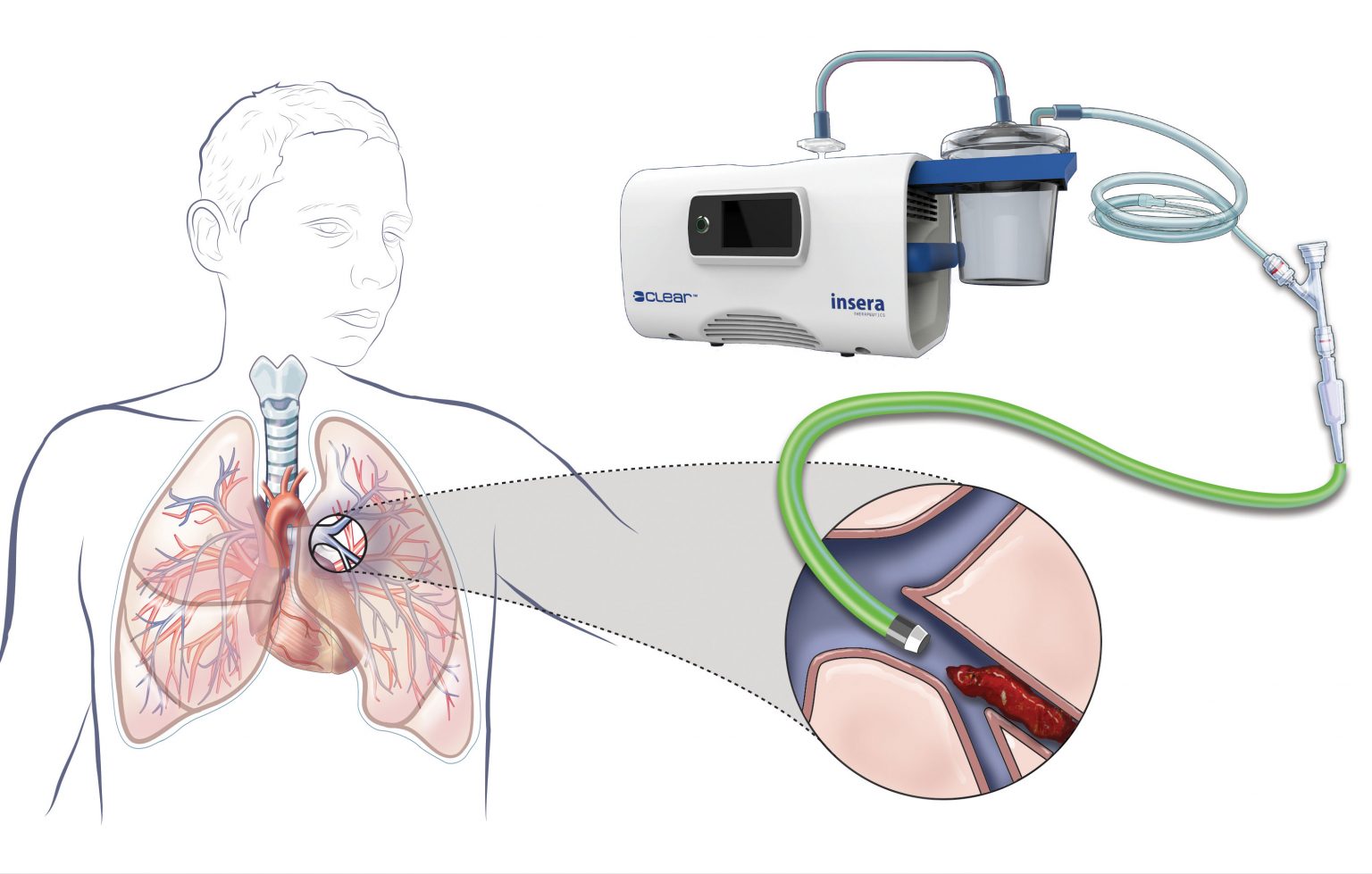 CLEAR™ Aspiration System Treating Pulmonary Embolism – Level Five Graphics